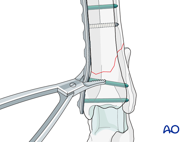 Medial plating for Simple extraarticular fracture of the distal tibia