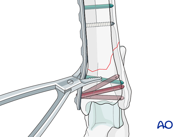 Medial plating for Simple extraarticular fracture of the distal tibia