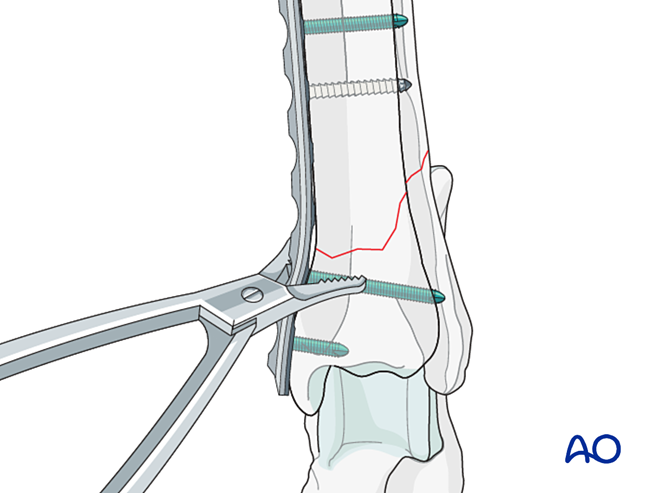 Medial plating for Simple extraarticular fracture of the distal tibia