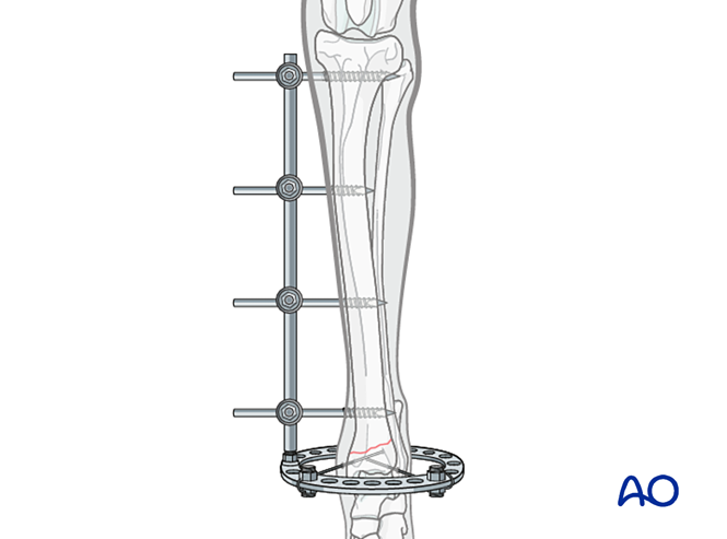 Hybrid external skeletal fixation for Simple extraarticular fracture of the distal tibia