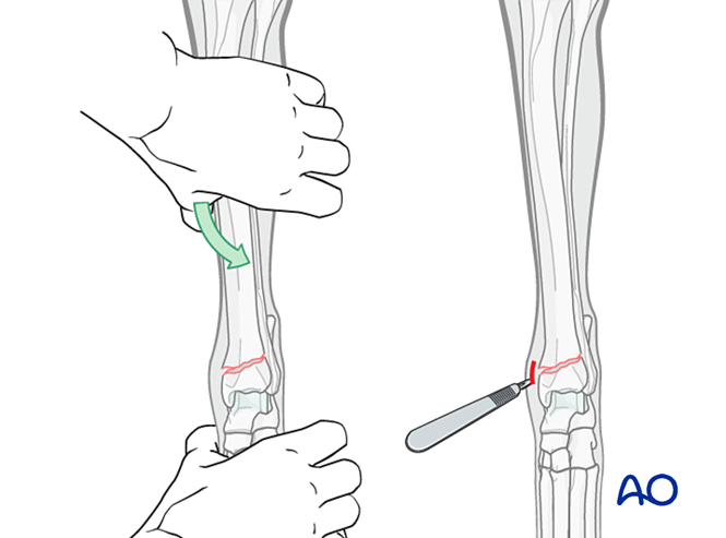 Hybrid external skeletal fixation for Simple extraarticular fracture of ...