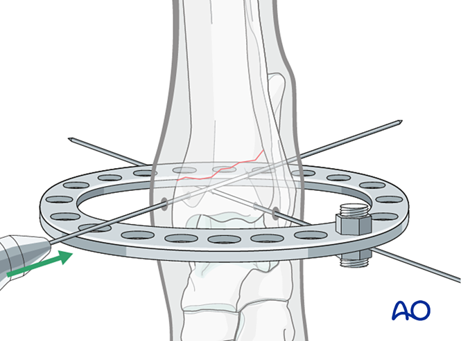 Hybrid external skeletal fixation for Simple extraarticular fracture of ...