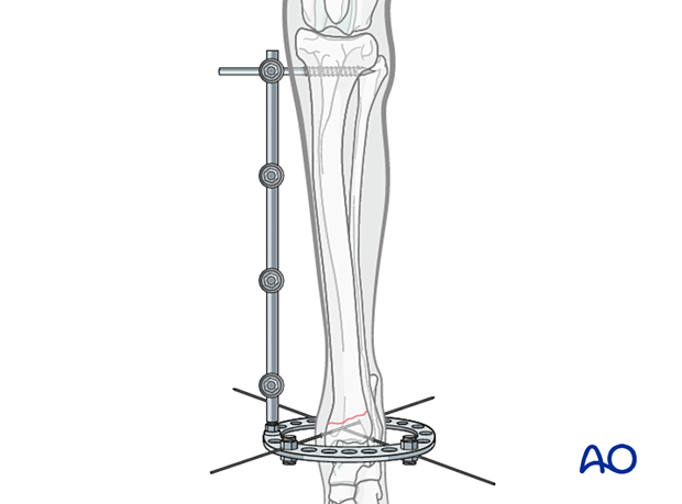 Hybrid external skeletal fixation for Simple extraarticular fracture of ...
