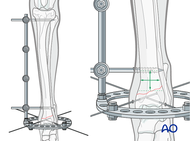 Hybrid external skeletal fixation for Simple extraarticular fracture of ...