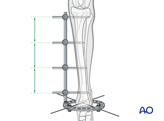 Hybrid external skeletal fixation for Simple extraarticular fracture of the distal tibia