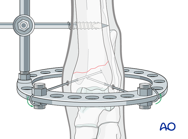 Hybrid external skeletal fixation for Simple extraarticular fracture of ...