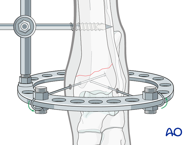 Hybrid external skeletal fixation for Simple extraarticular fracture of the distal tibia
