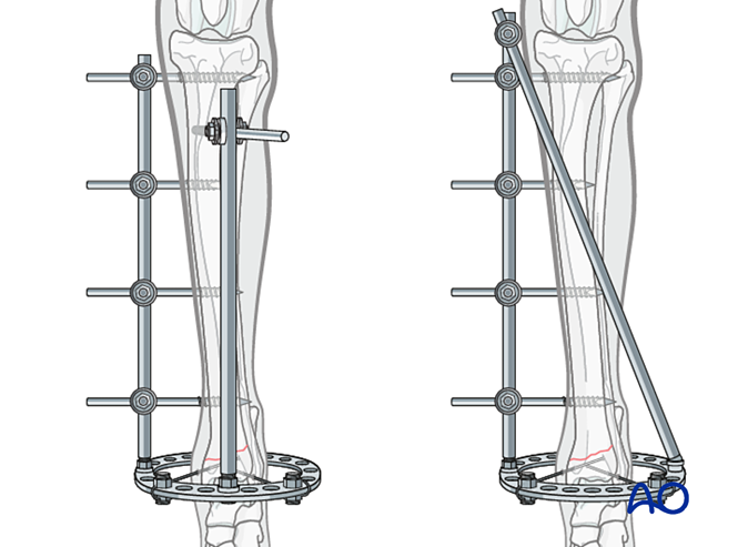 Hybrid external skeletal fixation for Simple extraarticular fracture of ...