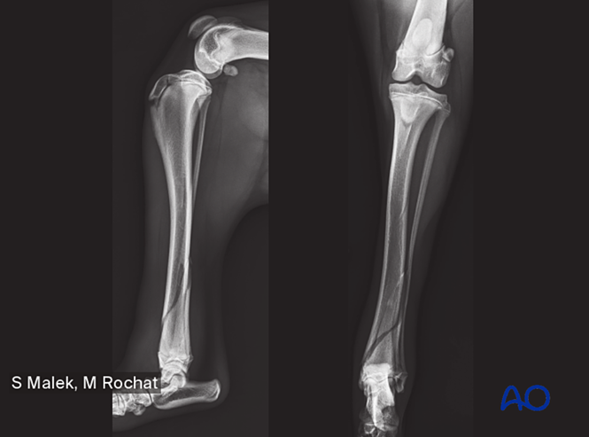 Hybrid external skeletal fixation for Simple extraarticular fracture of ...