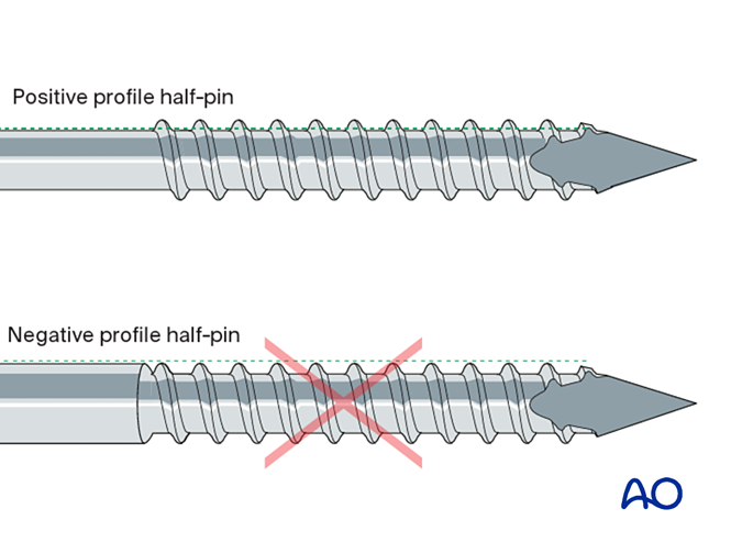 Hybrid external skeletal fixation for Simple extraarticular fracture of ...