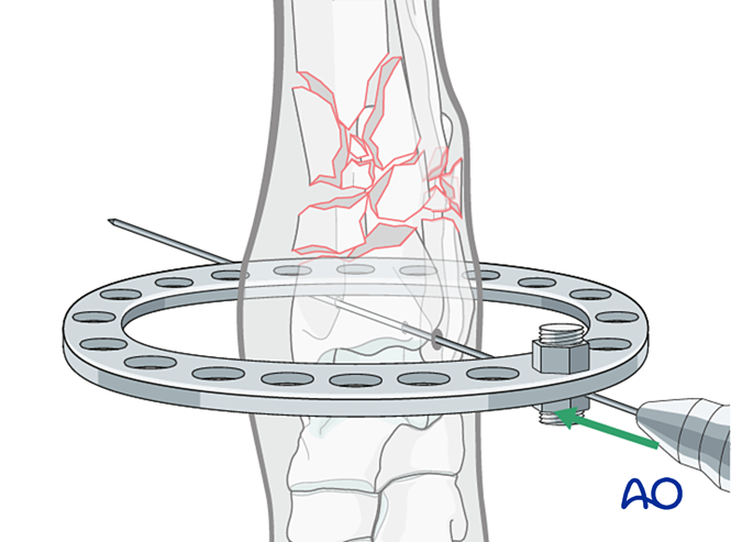 Hybrid external fixation for Complex extraarticular fracture of the ...