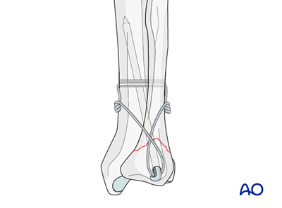 Pin and tension band fixation for Partial articular lateral malleolar ...