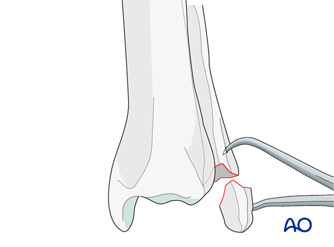 Screw fixation of the lateral malleolus for Partial articular lateral ...