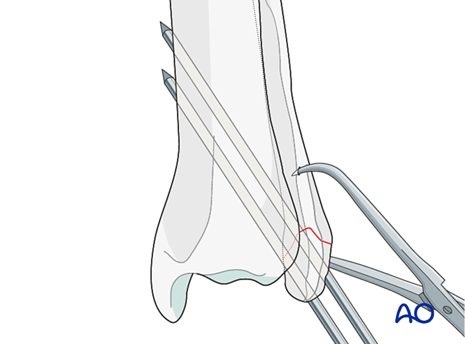Pin and tension band fixation for Partial articular lateral malleolar ...