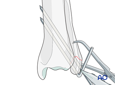 Pin and tension band fixation for Partial articular lateral malleolar ...