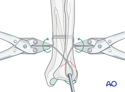 Pin and tension band fixation for Partial articular lateral malleolar ...