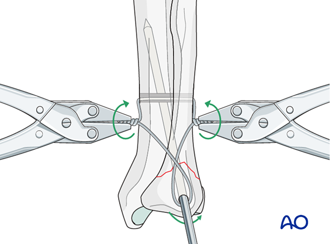 Pin and tension band fixation for Partial articular lateral malleolar ...