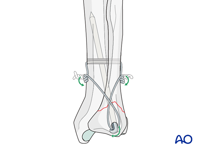 Pin and tension band fixation for Partial articular lateral malleolar ...