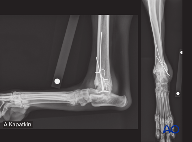 Pin and tension band fixation for Partial articular lateral malleolar ...