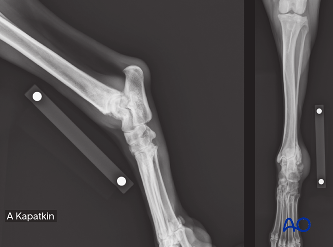Pin and tension band fixation for Partial articular lateral malleolar ...