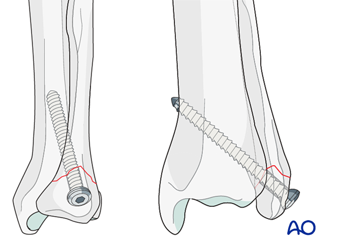 Screw fixation of the lateral malleolus for Partial articular lateral ...