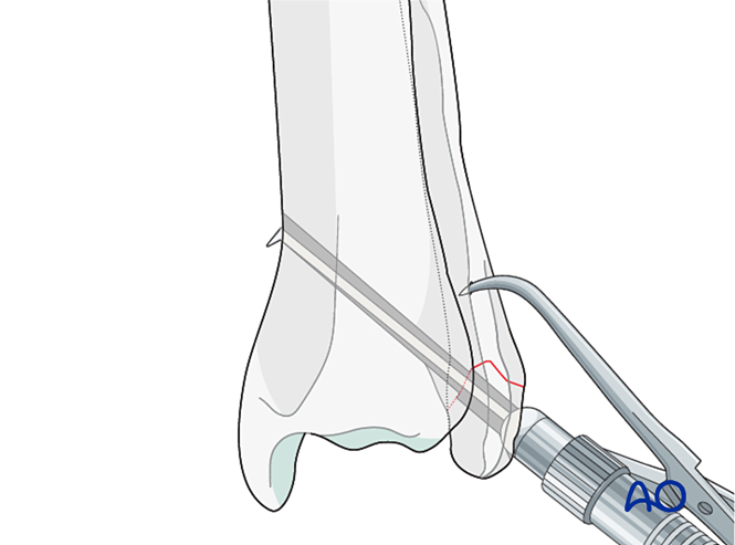 Screw fixation of the lateral malleolus for Partial articular lateral ...