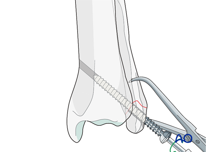 Screw fixation of the lateral malleolus for Partial articular lateral ...
