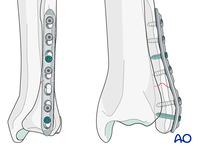Screw fixation of the lateral malleolus for Partial articular lateral ...