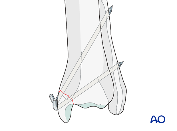 Pin and tension band fixation for Partial articular medial malleolar ...
