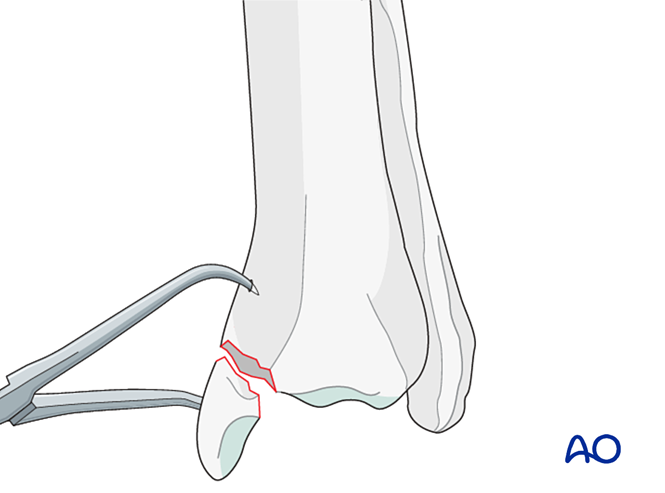 Pin and tension band fixation for Partial articular medial malleolar ...
