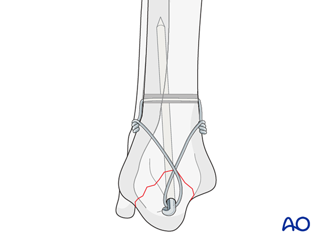 Pin and tension band fixation for Partial articular medial malleolar ...