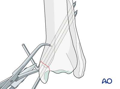 Pin and tension band fixation for Partial articular medial malleolar ...