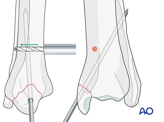 Pin and tension band fixation for Partial articular medial malleolar ...