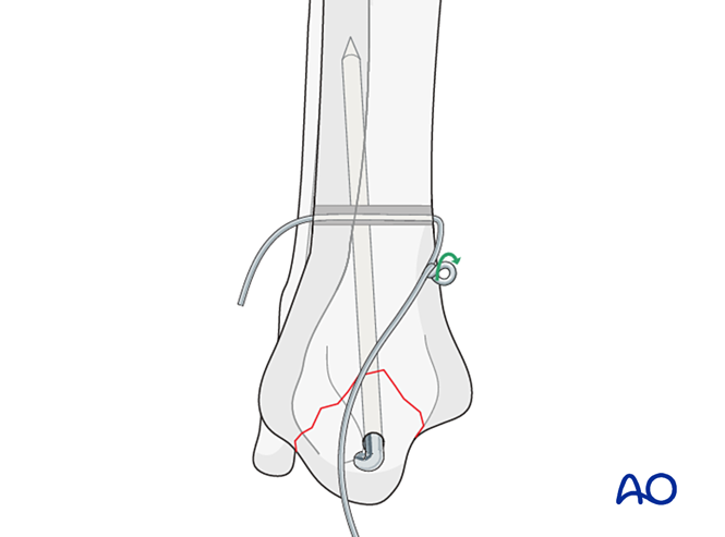 Pin and tension band fixation for Partial articular medial malleolar ...
