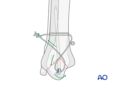 Pin and tension band fixation for Partial articular medial malleolar ...