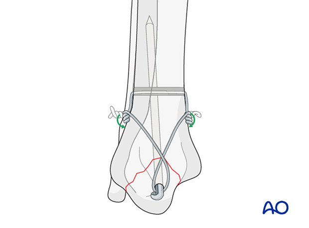 Pin and tension band fixation for Partial articular medial malleolar ...