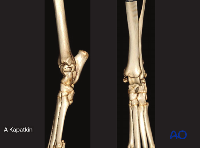 Pin and tension band fixation for Partial articular medial malleolar ...