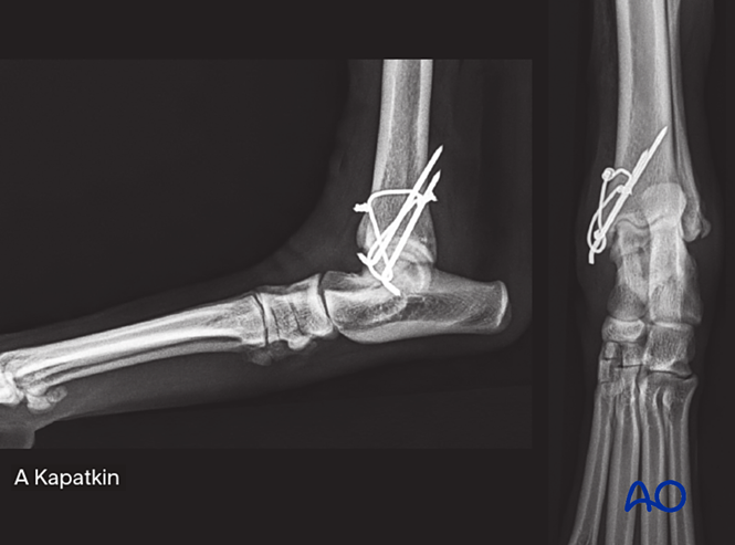 Pin and tension band fixation for Partial articular medial malleolar ...