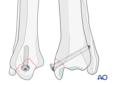 Screw fixation of the medial malleolus for Partial articular medial ...