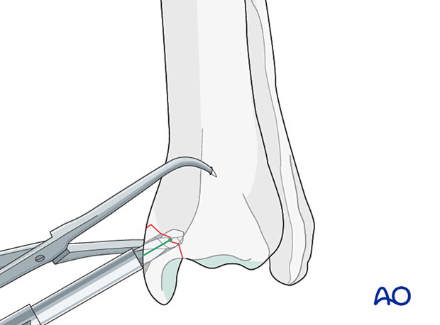 Screw fixation of the medial malleolus for Partial articular medial ...