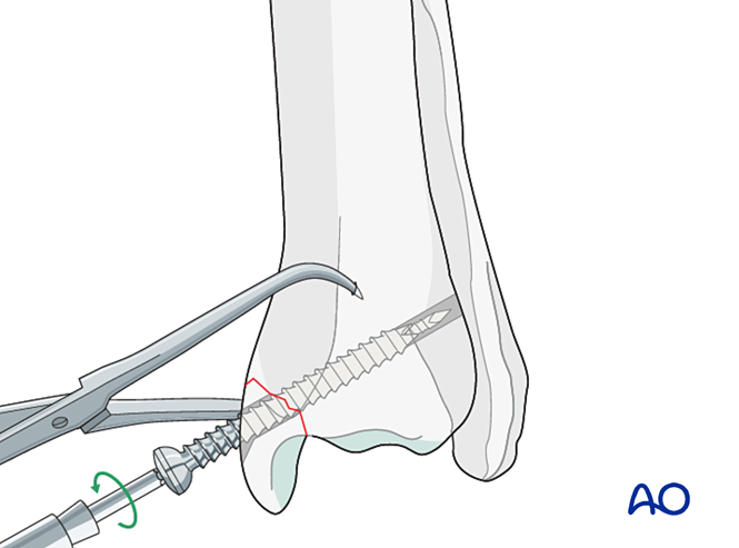 Screw fixation of the medial malleolus for Partial articular medial ...