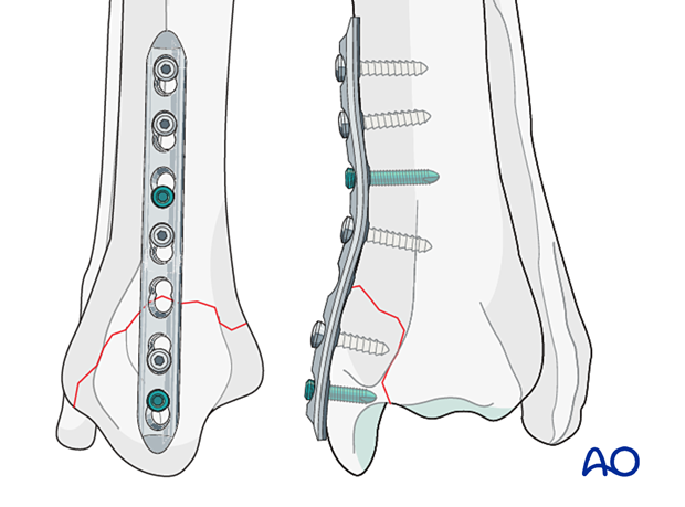 Screw fixation of the medial malleolus for Partial articular medial ...