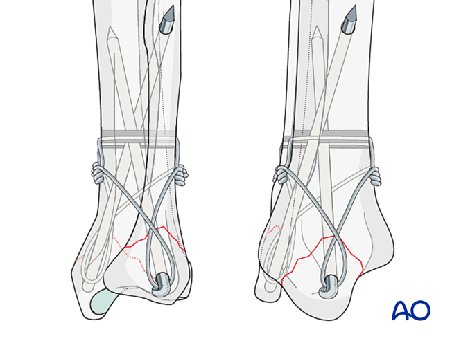 Pin and tension band fixation for Partial articular multimalleolar ...