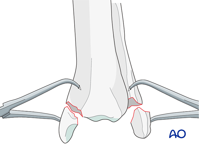 Pin and tension band fixation for Partial articular multimalleolar ...