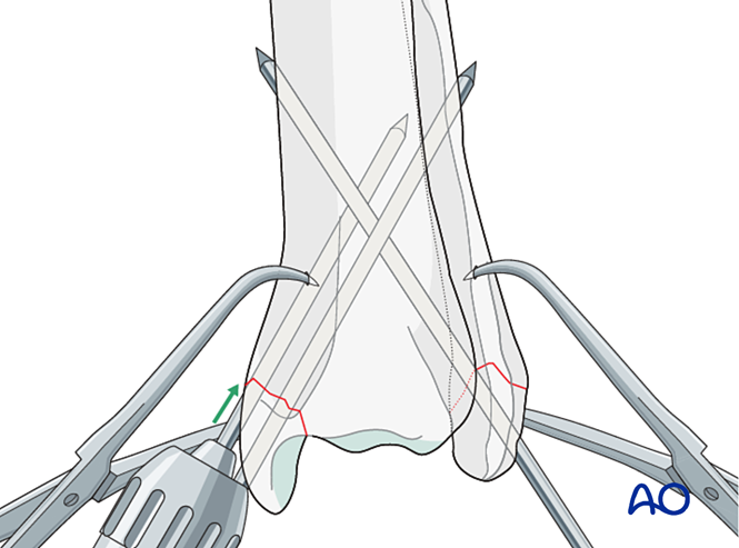 Pin and tension band fixation for Partial articular multimalleolar ...