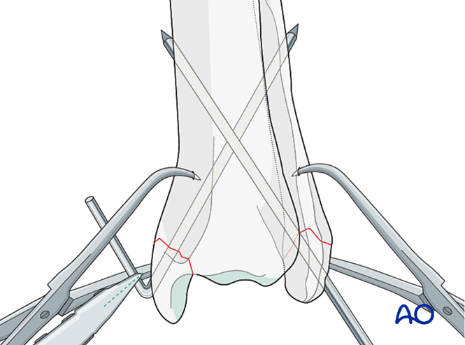 Pin and tension band fixation for Partial articular multimalleolar ...