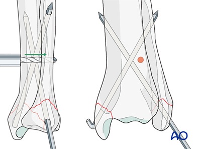 Pin and tension band fixation for Partial articular multimalleolar ...