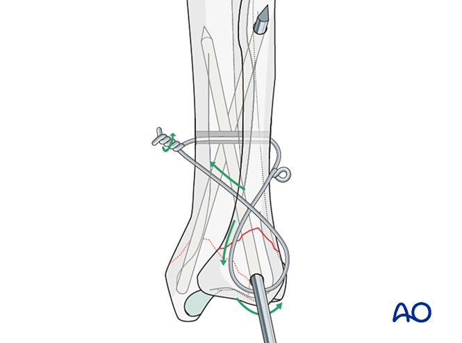 Pin and tension band fixation for Partial articular multimalleolar ...