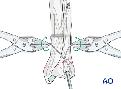 Pin and tension band fixation for Partial articular multimalleolar ...