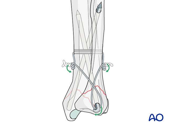 Pin and tension band fixation for Partial articular multimalleolar ...